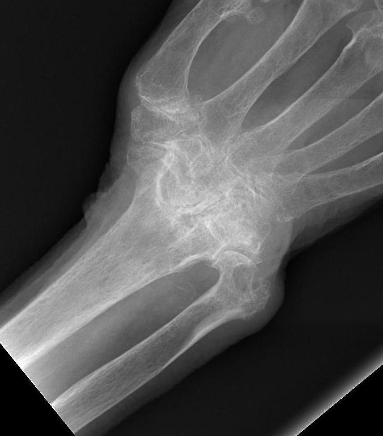 Rheumatoid Wrist | The Bone School